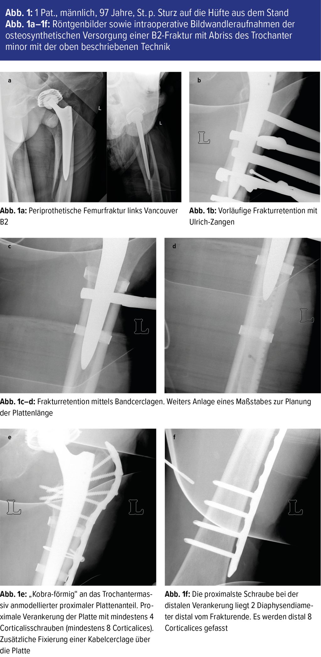 Operative Versorgung von periprothetischen Femurfrakturen bei liegende - Orthopädie ...